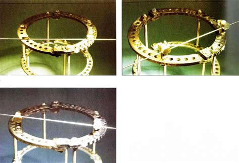 一文了解 胫骨近端骨折：环形外固定架固定架克氏针膝关节胫骨骨折 健康界