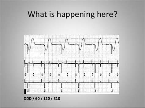 Pacemaker Basics
