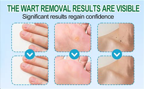 Skin Tag Remover Mole And Wart Remover Liquid Wart Remover Remove