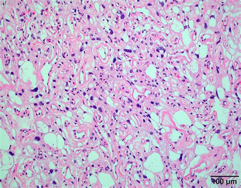Meningioma Histology Meningioma Dna Methylation Groups Identify