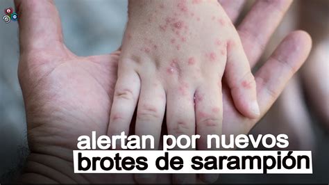 Los Cdc Alertan Por Nuevos Brotes De Sarampión Entre Niños Y