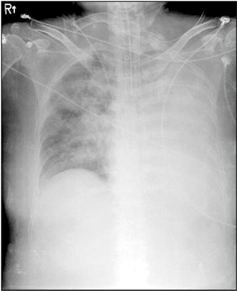 Chest Radiography Showed A Completely Opacified Left Hemithorax