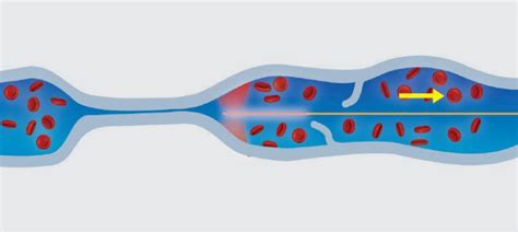 Laser Treatment For Varicose Veins Vein Clinic Perth