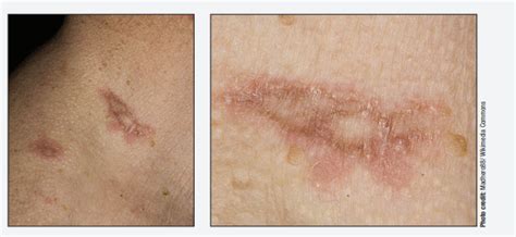 Off Label Pearl Elastosis Perforans Serpiginosa The Dermatology Digest