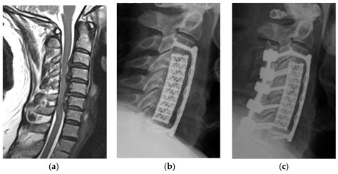 Radiological And Clinical Outcome After Multilevel Anterior Cervical