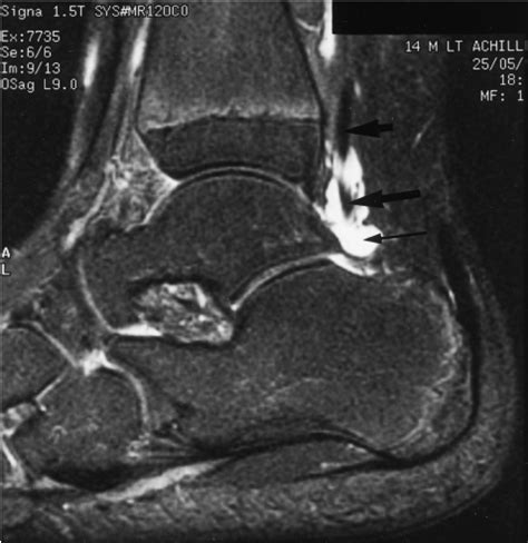 Flexor Hallucis Longus Mri Axial T2 Mri Image Showing Fluid Within The