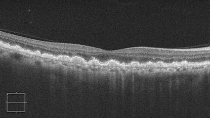Oct Drusen Eyeguru