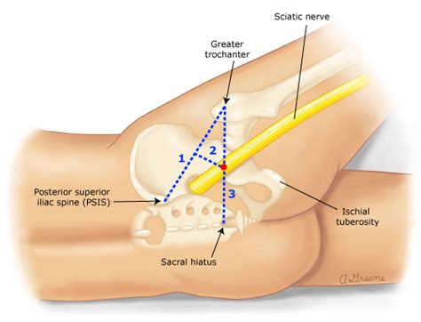 Sciatic Nerve Block