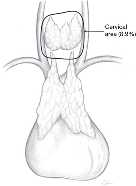 Definitions And Standard Indications Of Minimally Invasive Techniques In Thymic Surgery Pmc