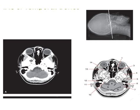 Iac Temporal Bones Cross Section — Printable Worksheet