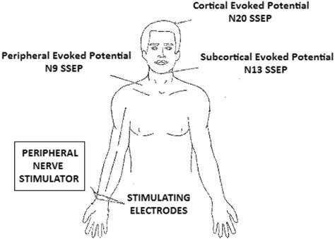 A Good Outcome After Absence Of Bilateral N20 Sseps Post Cardiac Arrest
