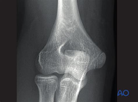 Distal Humeral Surgical And Developmental Anatomy