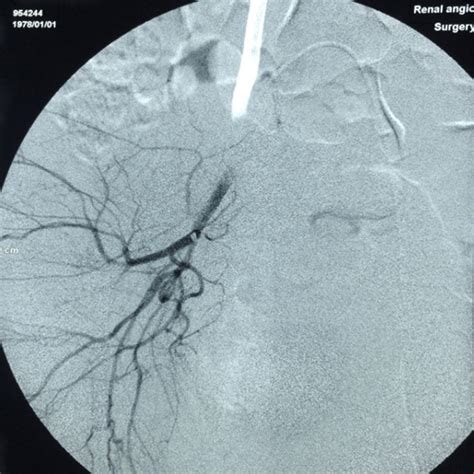 Angiographic Embolization Of Uterine Artery Download Scientific Diagram