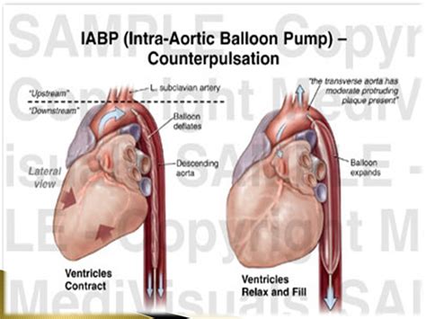 Where Does A Balloon Pump Sit In The Heart At Hayden Seton Blog