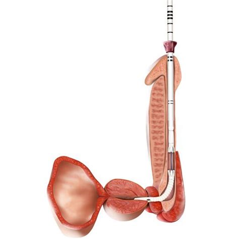Exime® Temporary Prostatic Stent Stojan Medical Systems