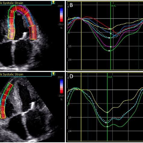 Left Ventricular Lv And Right Ventricular Rv Strain Analysis Using