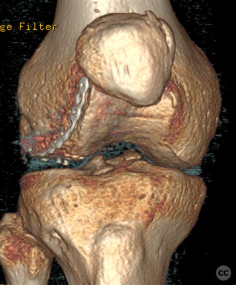 Destructive Osteochondral Fracture Of The Lateral Femoral Condyle