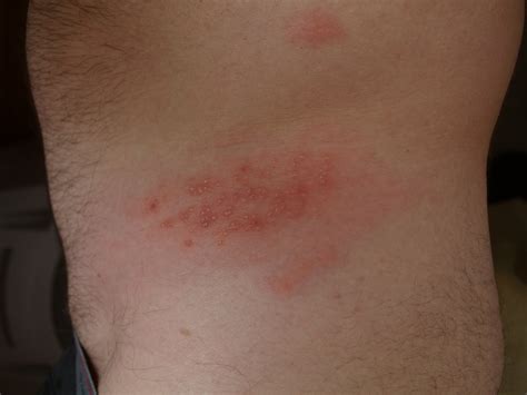 Shingles Rash Contagious
