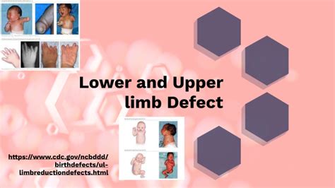 Upper And Lower Limb Defect By Olivia Martins On Prezi