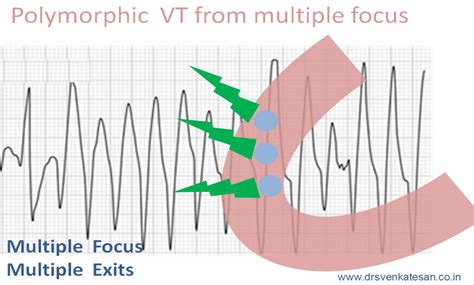 Different “avatars” Of Ventricular Tachycardia Multifocal Vs