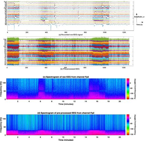 Figure 2 From Adaptive Median Feature Baseline Correction For Improving Recognition Of Epileptic