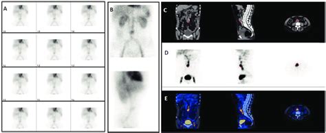Increased Uptake In The Midline Of The Abdomen Adjacent To The Aorta