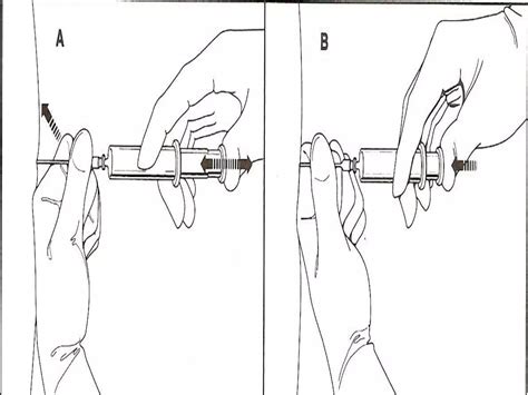 Epidural Anaesthesia Pptx