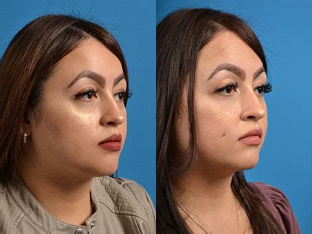 Dimple Surgery Before And After Renew Physical Therapy