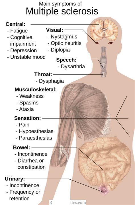 Diferença Entre Als E Ms Als Vs Ms Saúde 2025