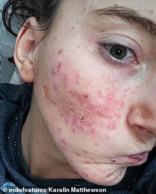 Woman With Skin Picking Disease Is Taking Back Her Life After Suffering