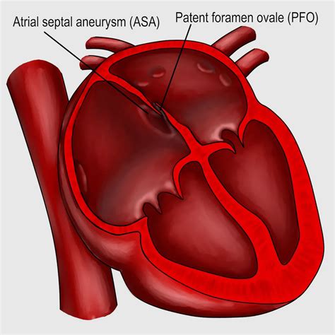 Patent Foramen Ovale Pfo Closure