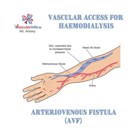 Treatments Vascular Info
