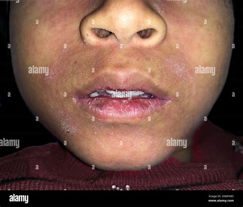 Angular Stomatitis Or Angular Cheilitis Or Perleche In Asian Little Boy