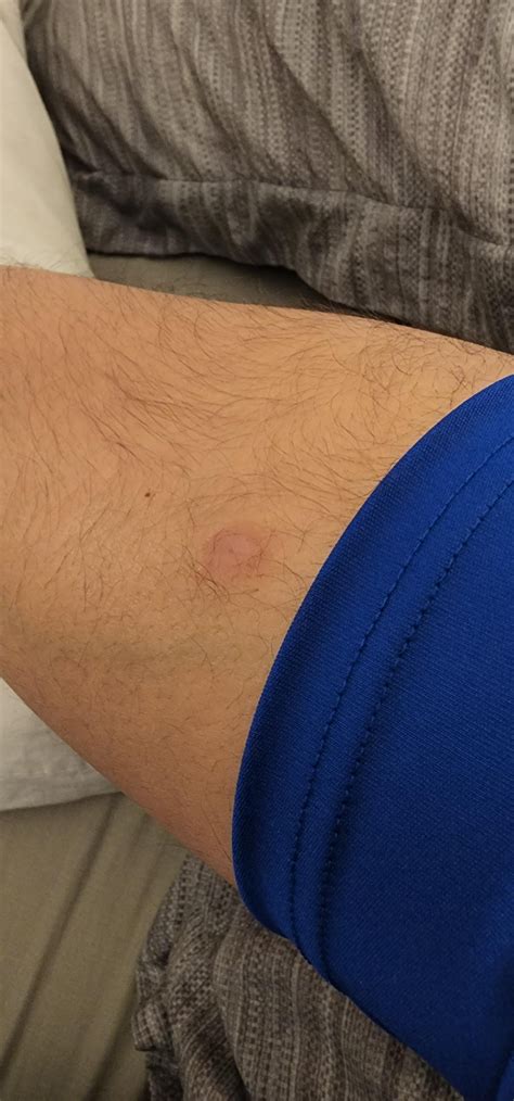 Does This Look Like Mrsa R Mrsa