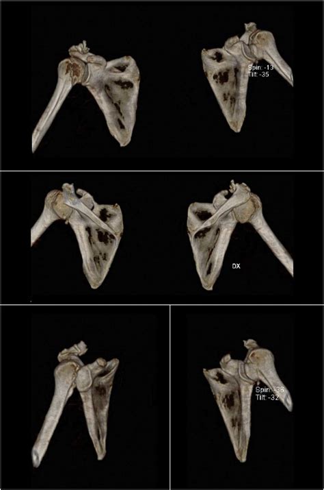 Ct Scan 3d Reconstruction Download Scientific Diagram