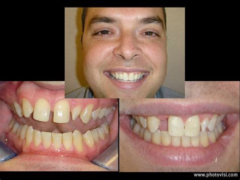 Invisalign On Teeth