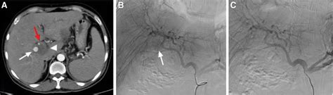 Hepatic Artery Pseudoaneurysm Caused By Chronic Pancreatitis Medicine