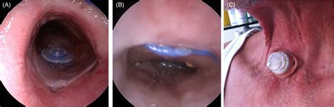 Inserted Button‐shaped Prosthesis A Tracheal View Of The Prosthesis Download Scientific