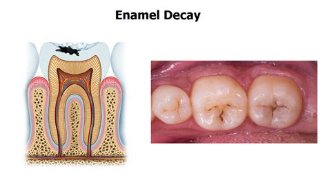 The 5 Stages Of Tooth Decay Types Of Decay Tooth Decay Project