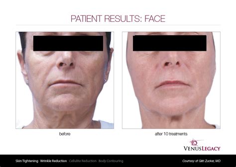 Perth Medical Cosmetic Clinic Face And Body Sculpting Venus Legacy Perth