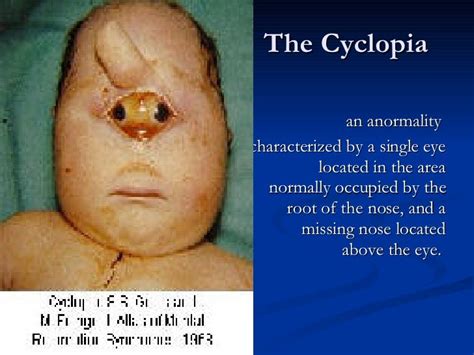Cyclops Disease
