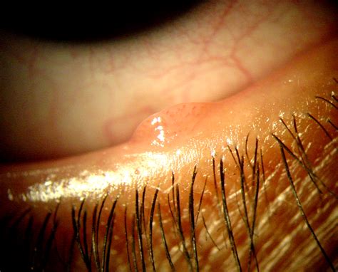 Papiloma Borde Del Párpado Inferior Atlas De Oftalmología