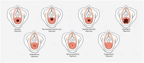 Hymenoplasty Surgery In Turkey Reconstructive Care Cayra Clinic