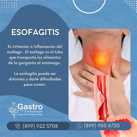 🔸esofagitis La Esofagitis Es Una Inflamación Del Esófago El Tubo Que Conecta La Garganta Con El