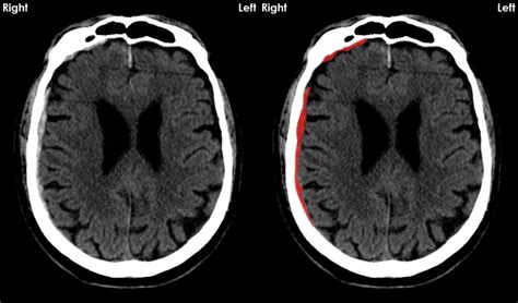 Ct Brain Image Gallery Sdh Small
