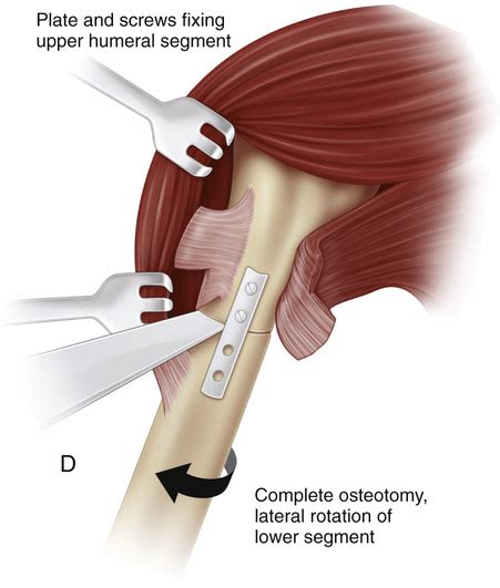 59 Lateral Rotation Osteotomy Of The Humerus Musculoskeletal Key