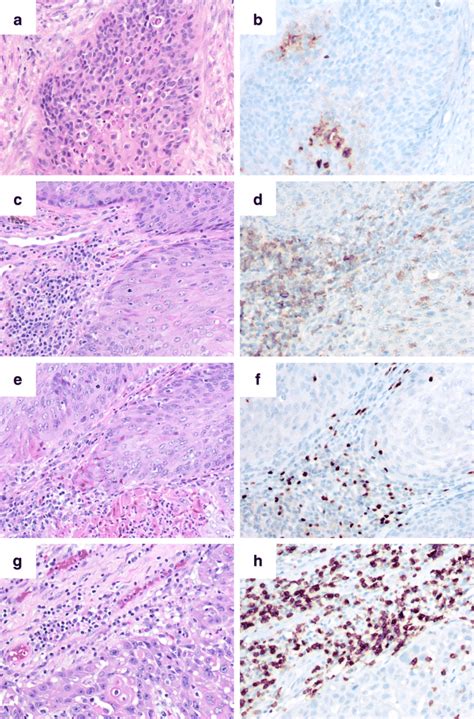 Photomicrographs Of Vulvar Squamous Cell Carcinoma A C E G Hande