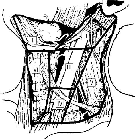 Table 1 From Neck Dissection Classification Update Revisions Proposed