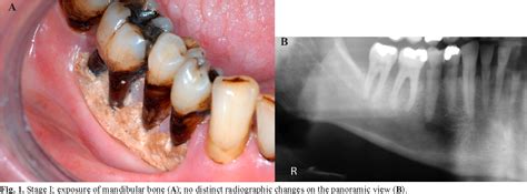 Osteoradionecrosis Of The Mandible A Review Idoctj