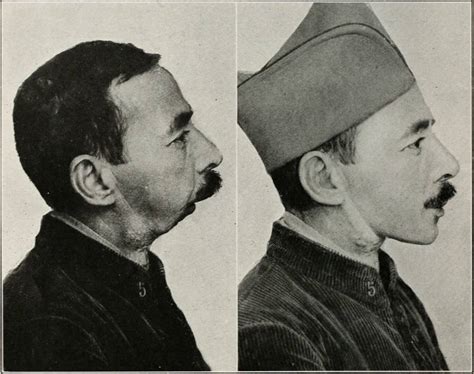 Harold Gillies The Surgeon Who Rebuilt The Faces Of Ww1 Veterans